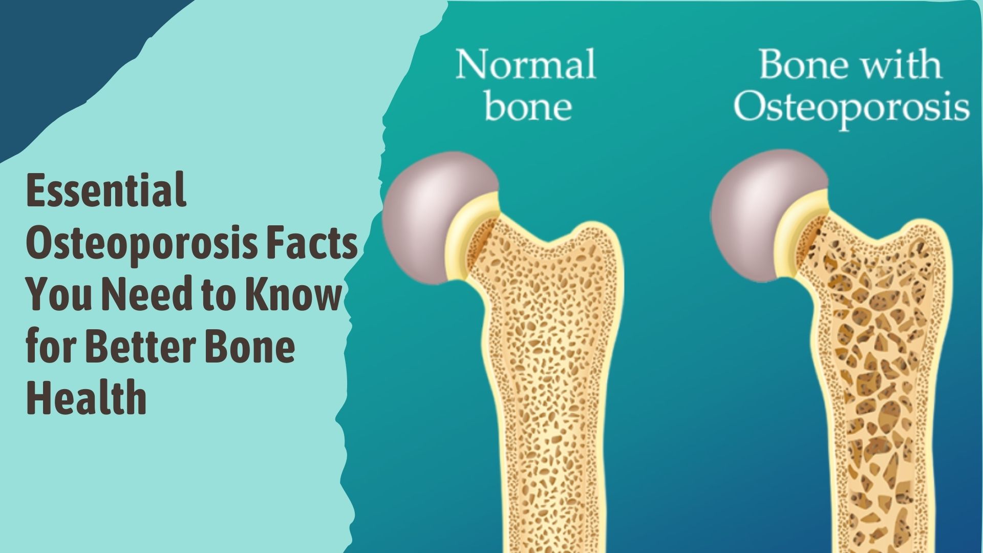 Essential Osteoporosis Facts You Need to Know for Better Bone Health ...